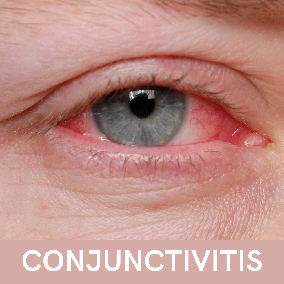 Conjunctivitis - Compassion Primary Care